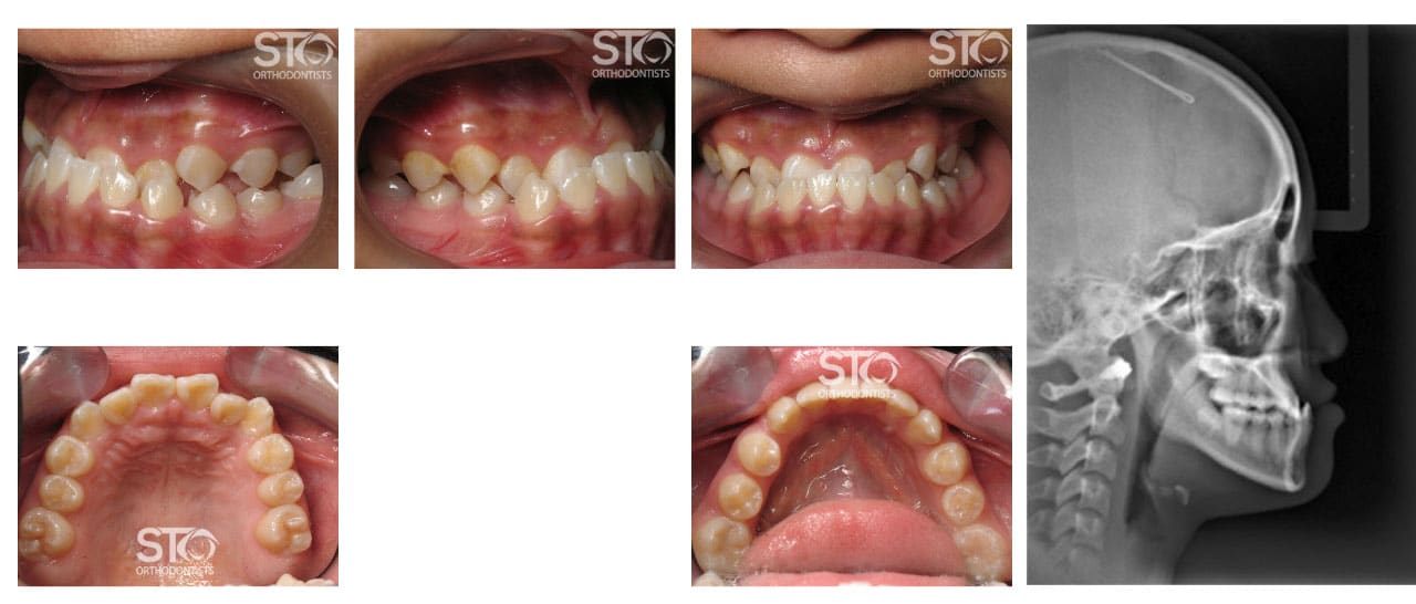 Overbite Correction Cost