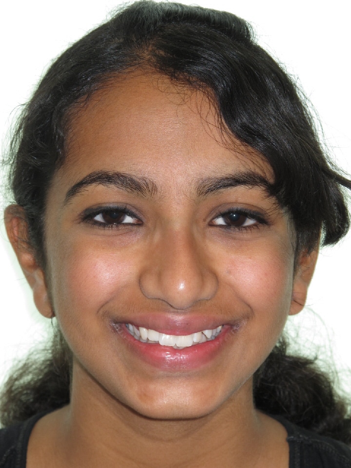 BEFORE AND AFTER - Braces can change your smile