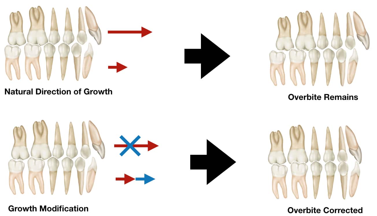 Non-Surgical Orthodontics in Scarborough STO Orthodontists