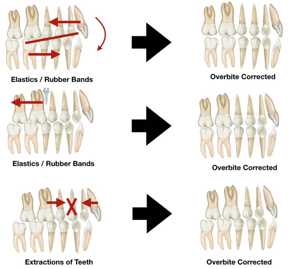 Non-Surgical Orthodontics in Scarborough STO Orthodontists